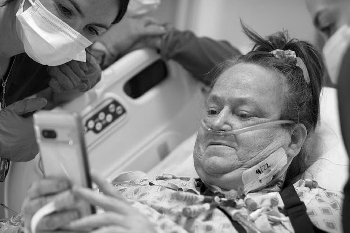 Umrla žena kojoj je transplantovan svinjski bubreg